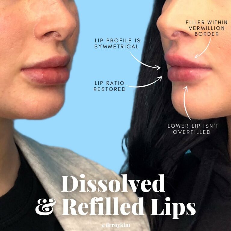 The Benefits of Dissolving and Refilling Lip Fillers – Roy Kim, MD