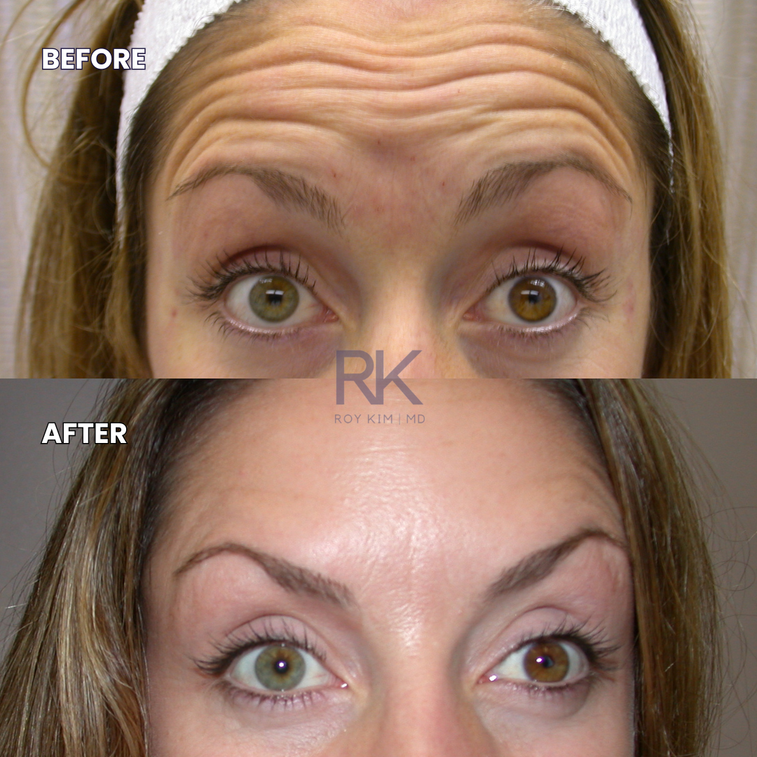 Before and After Botox: Transform Your Forehead & Glabella Lines : Roy ...
